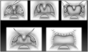 cirugía faringe - Clínica Gálvez